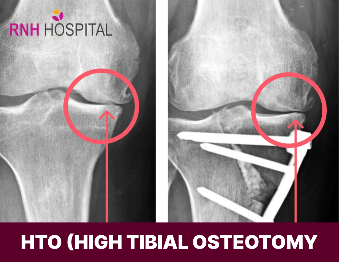 HTO-High Tibial Osteotomy | Restore Knees functionality